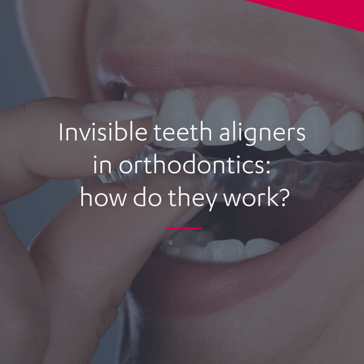 Clear aligners: comfortable orthodontic treatments with digital dental solutions – 3Shape Blog