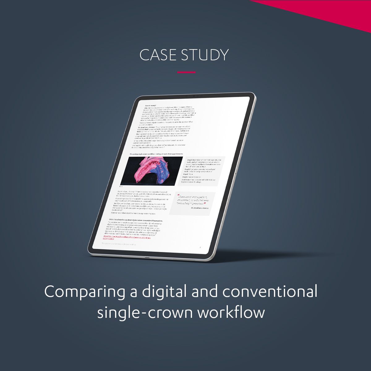 2 dental impression techniques - Case Study