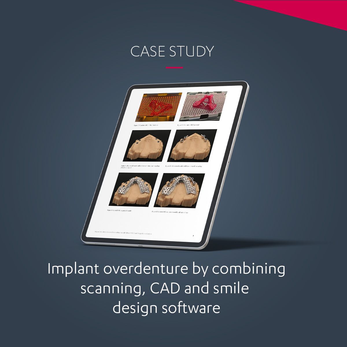 3Shape solutions for Implant overdenture creation | Case study
