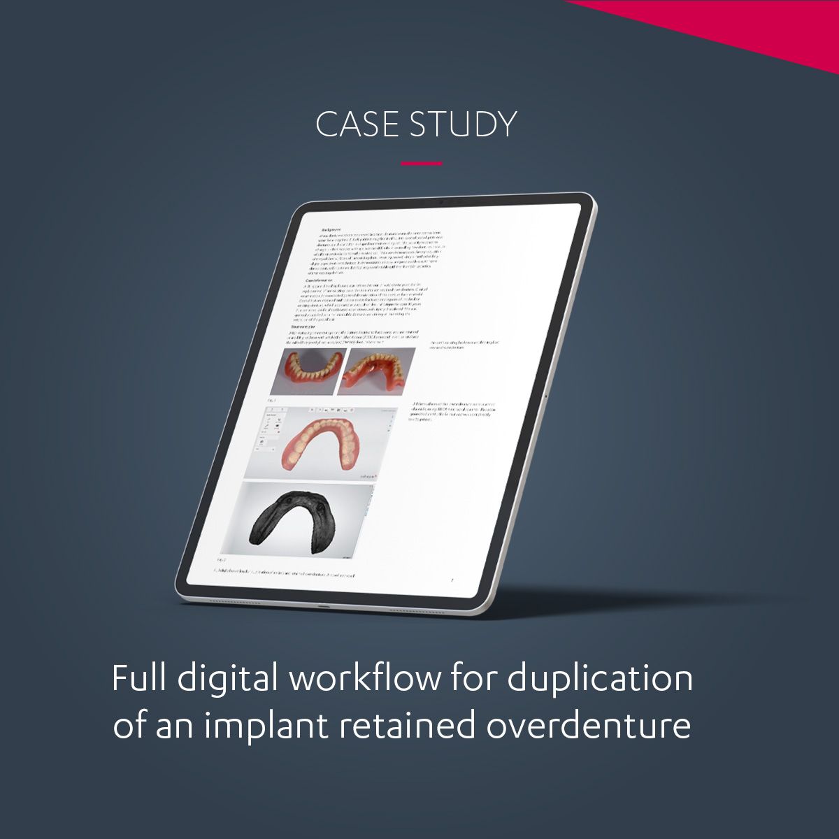 Copy denture digitally | Case study