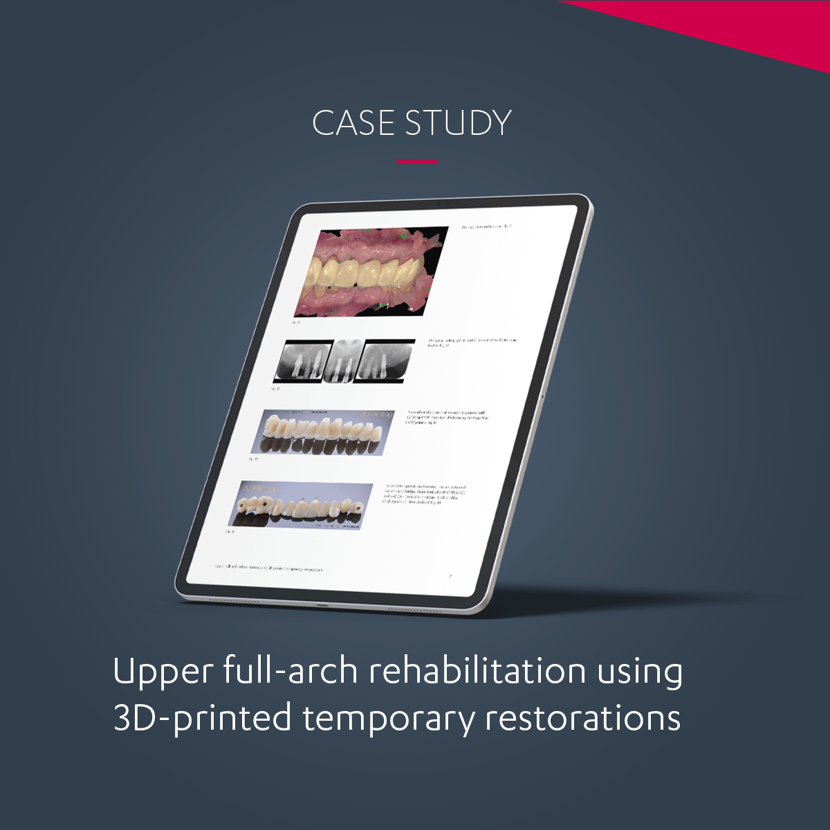 Implantologia digitale - Caso di studio 3Shape