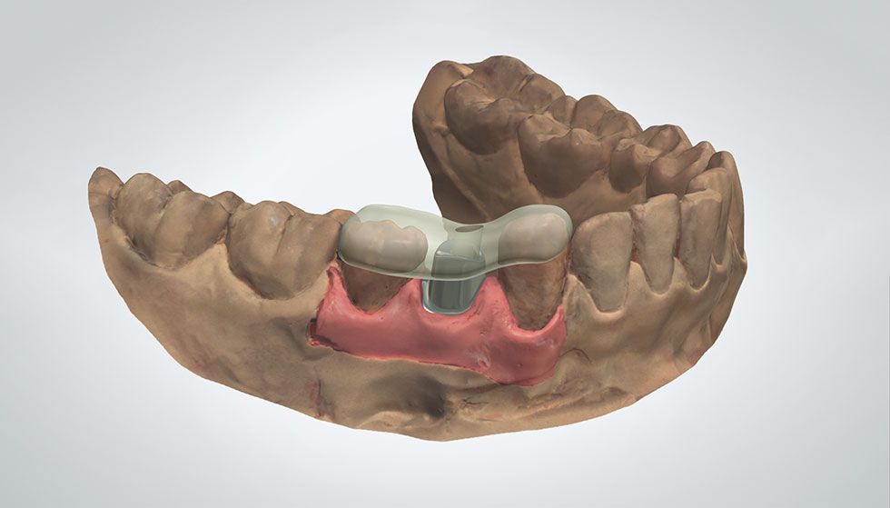 10 ways 3Shape made CADCAM technology so much better
