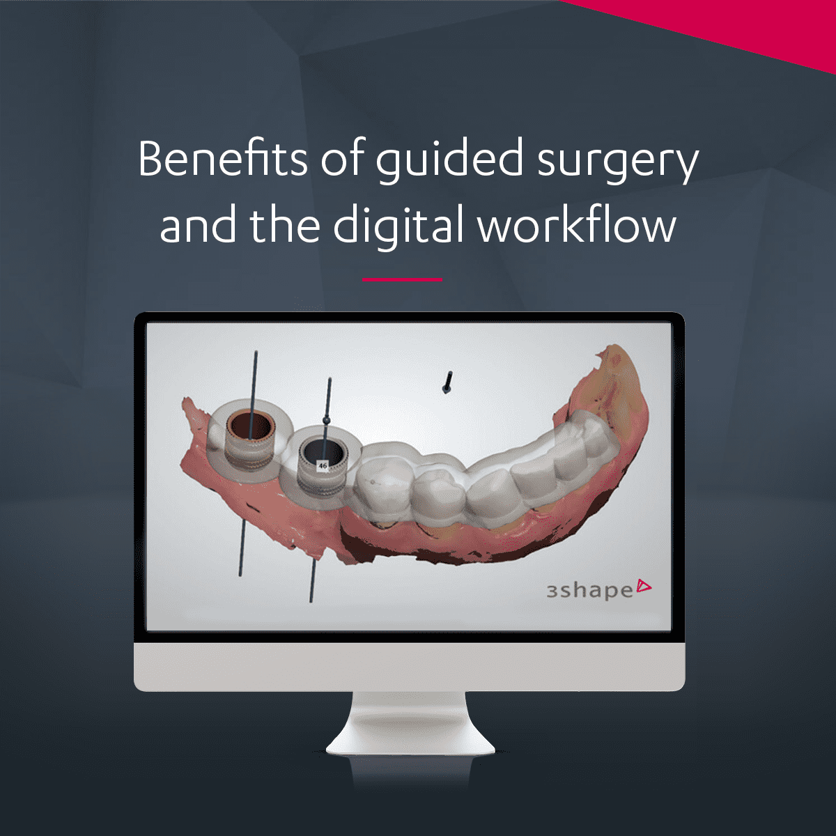 Benefits of guided surgery | Case study
