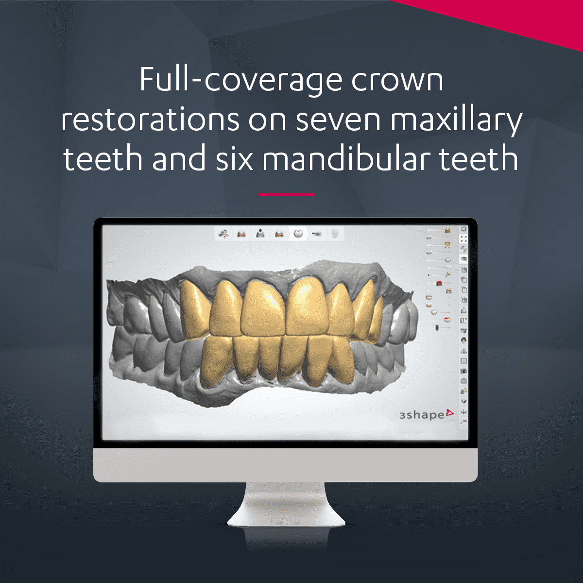 Full-coverage crown restorations | Case study