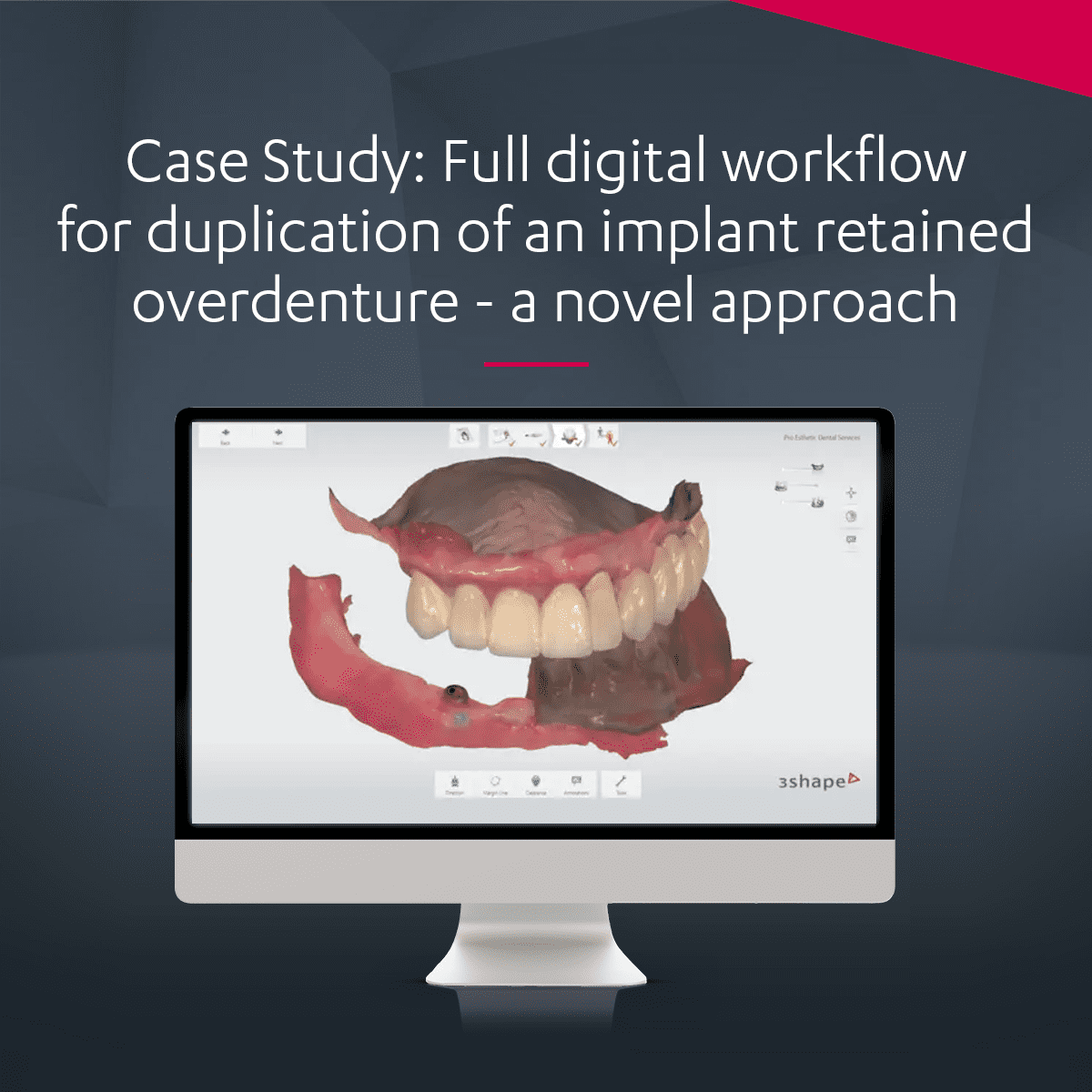 Full digital workflow for duplication of an implant retained overdenture | Case study