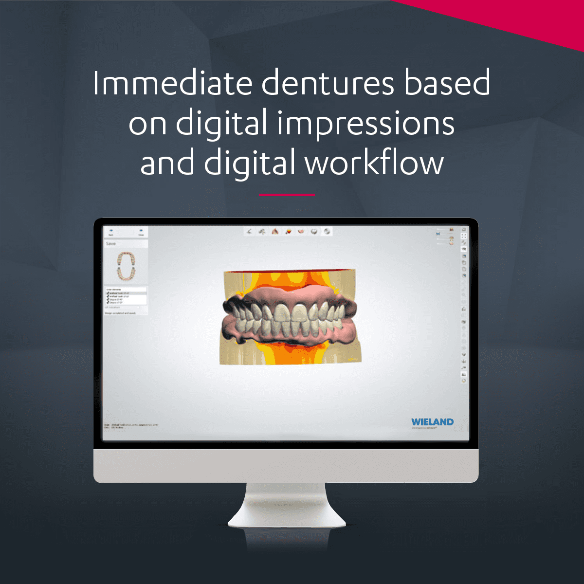 Immediate dentures based on digital impressions and digital workflow ...