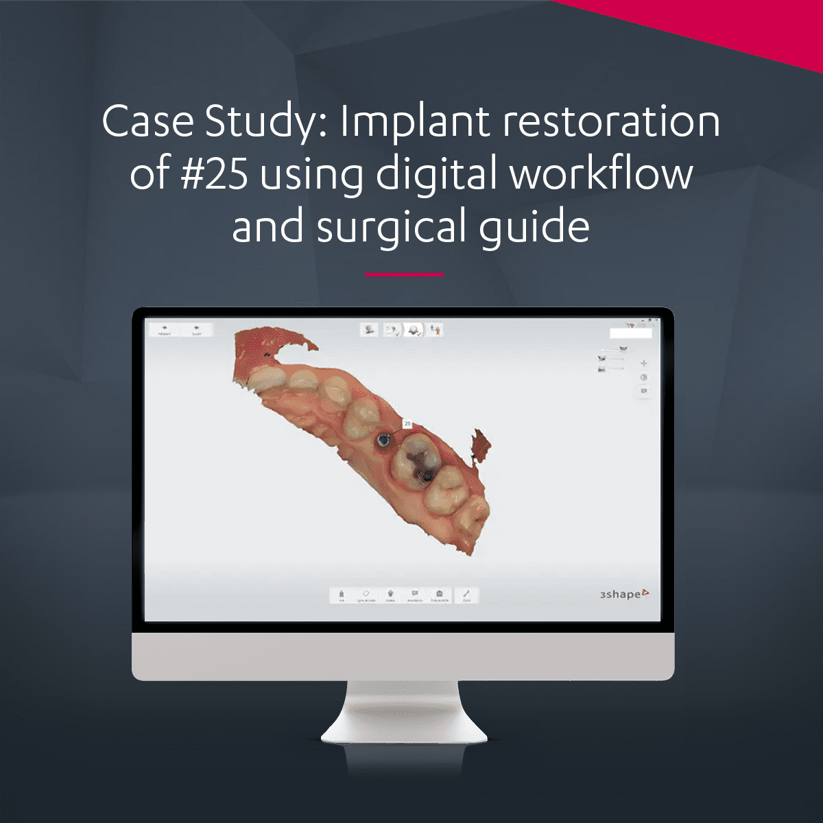 Restauración del implante mediante el flujo de trabajo digital y la ...