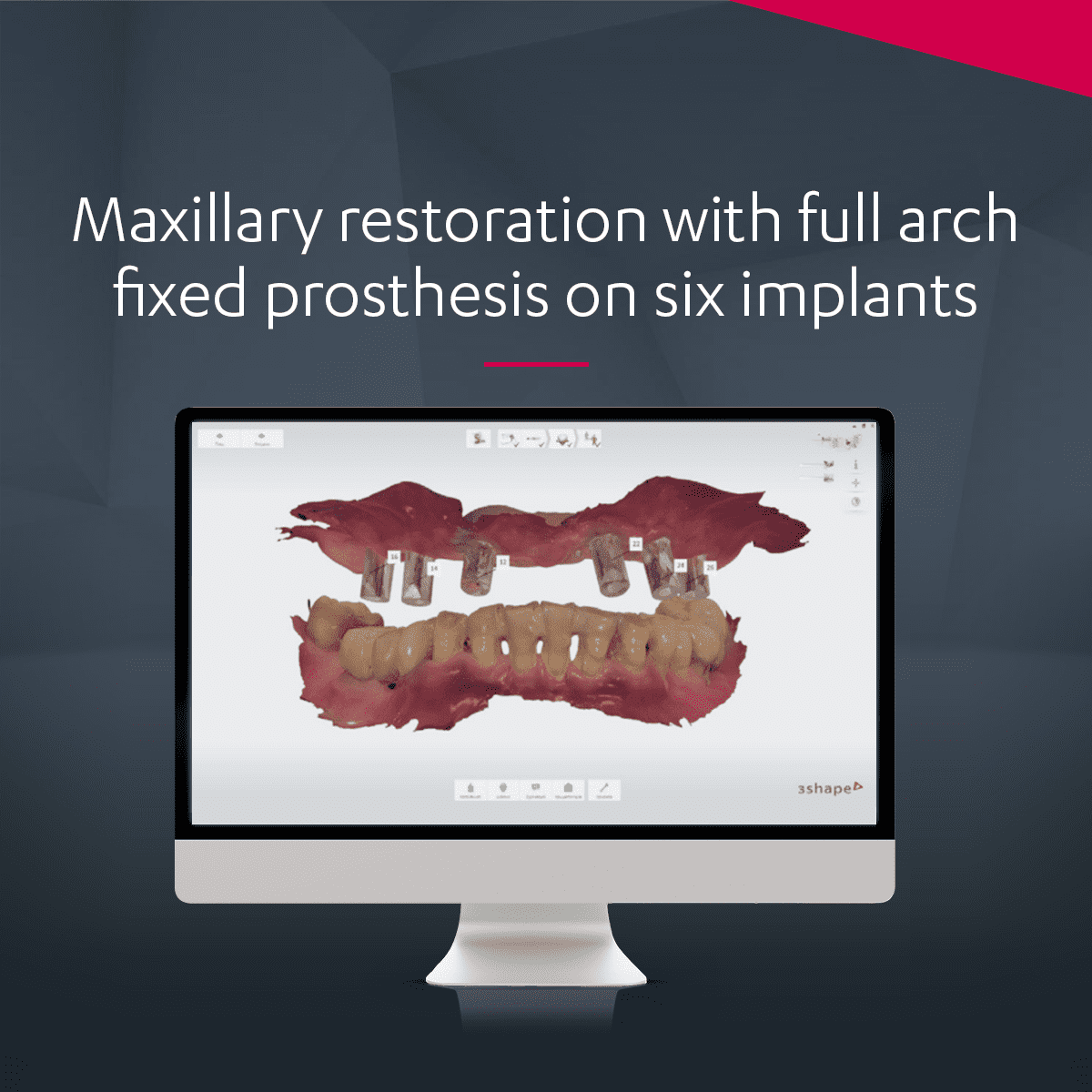 Maxillary restoration with full arch fixed prosthesis on six implants | Case Study