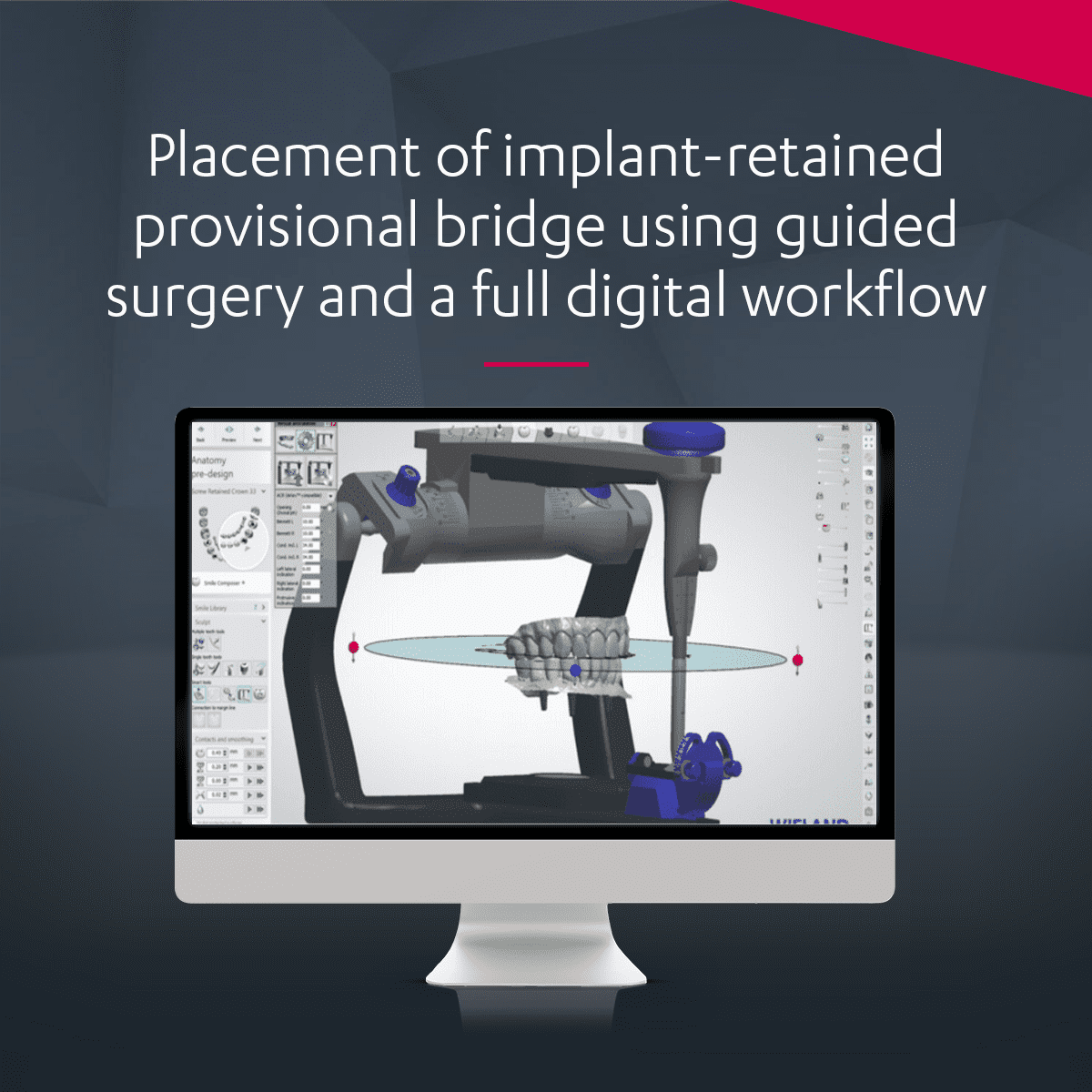 Placement of implant-retained provisional bridge using guided surgery | Case study