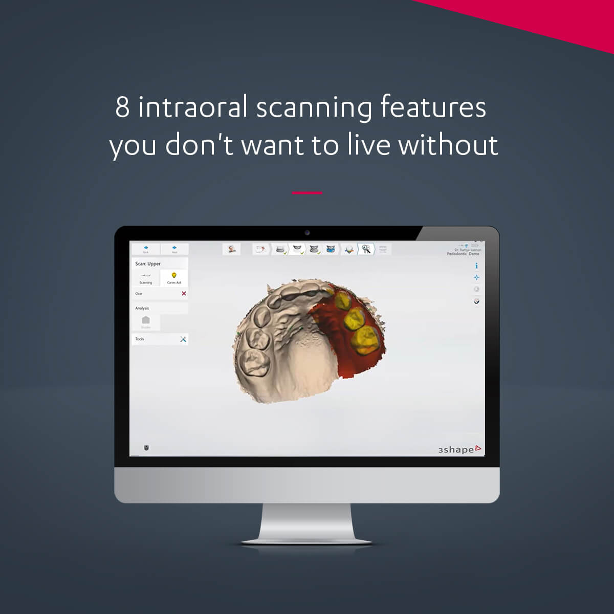 8 intraoral scanning features dentists cannot live without - Shape Blog