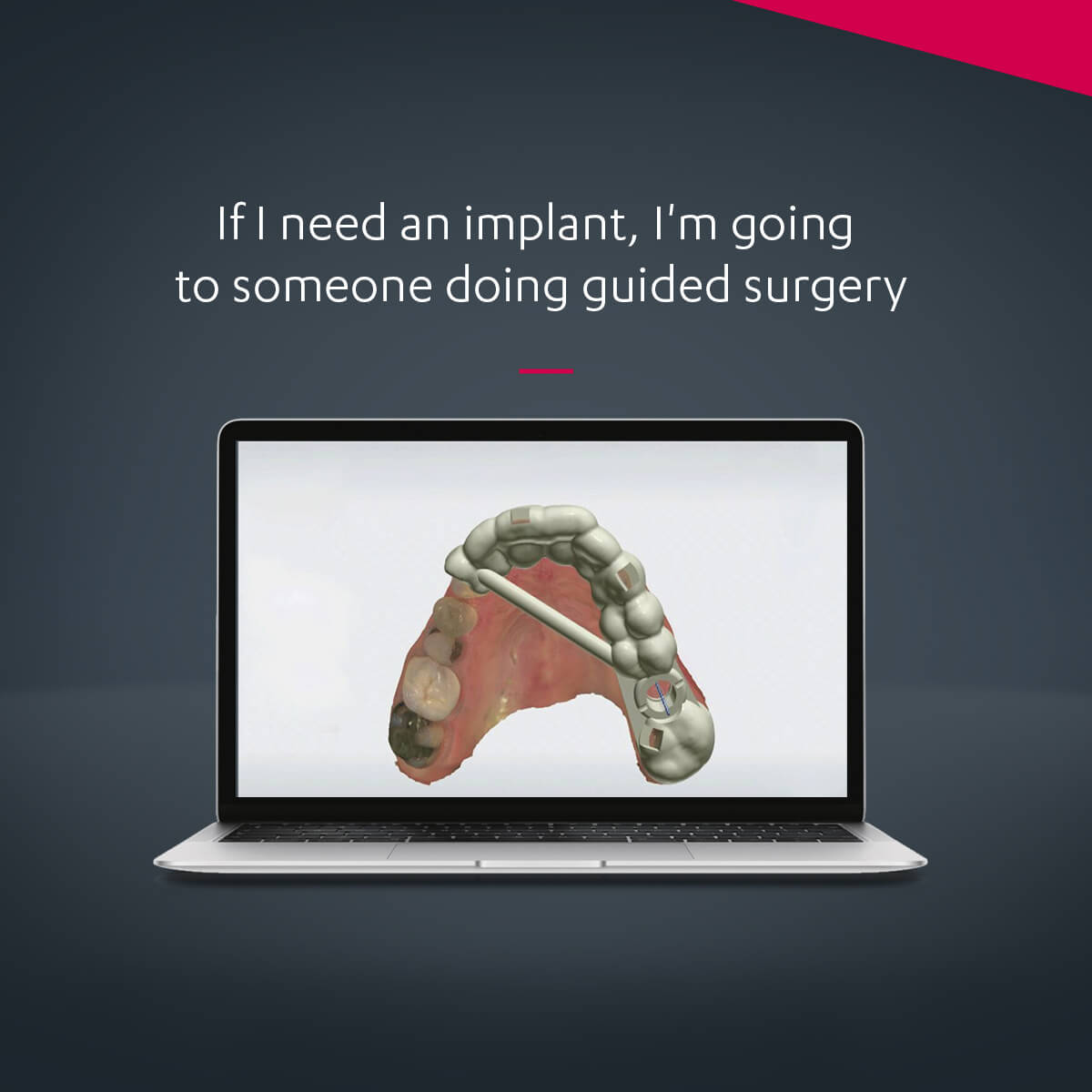 Need implant choose guided surgery – 3Shape Blog