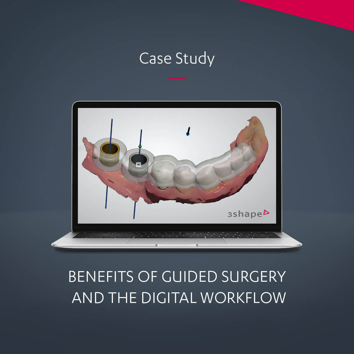 Benefits of guided surgery | Case study