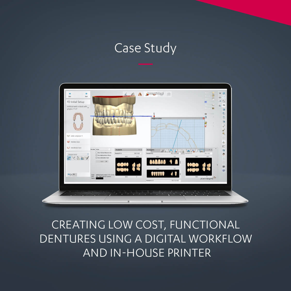 Create functional dentures with a digital workflow | Case Study