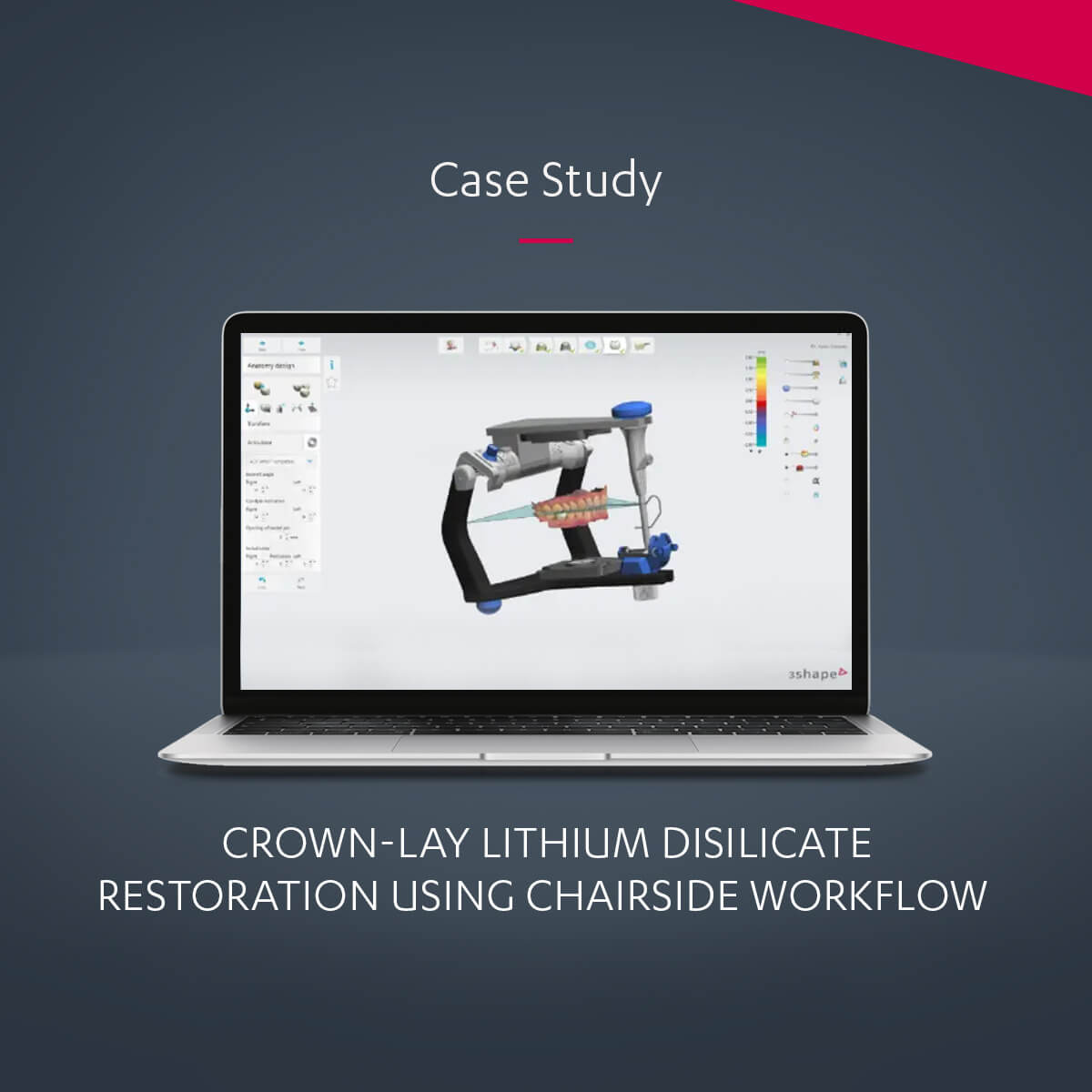 Crown-lay lithium disilicate restoration | Case study