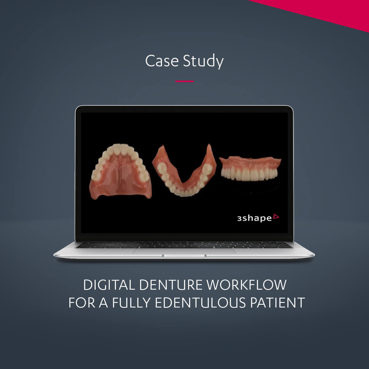 Digital denture workflow for a fully edentulous patient | Case study