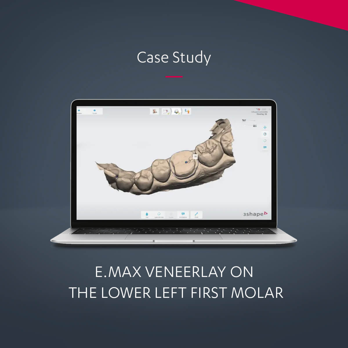 E-max veneerlay on the lower left first molar | Case study