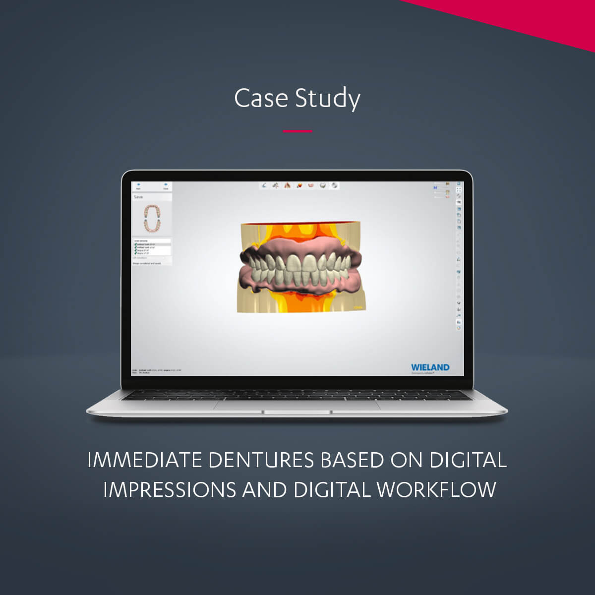 Immediate dentures based on digital impressions and digital workflow | Case study