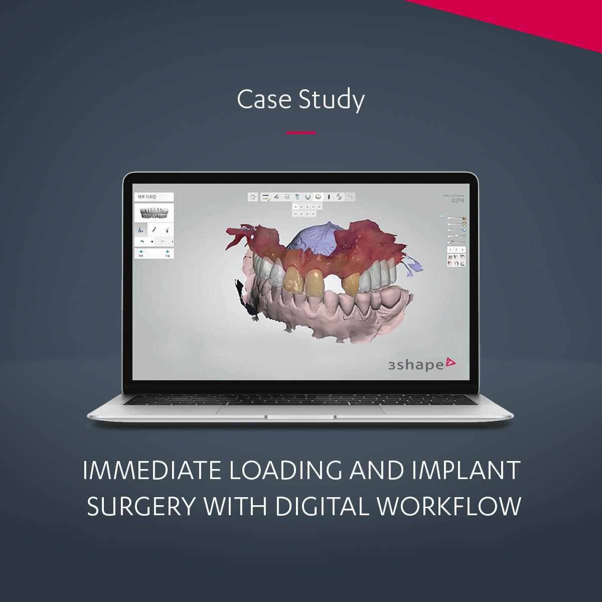 Immediate loading and implant surgery | Case study