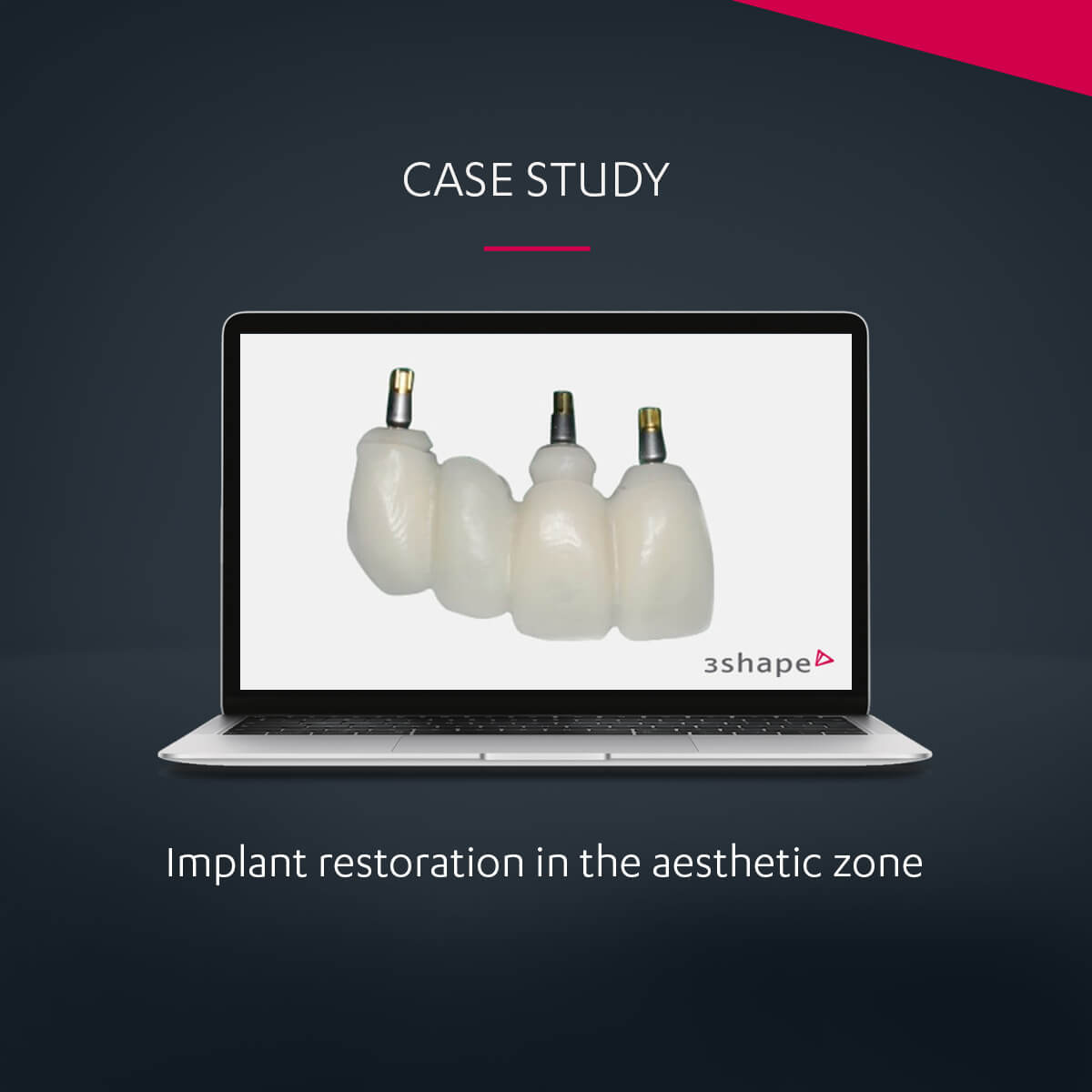 Implant restoration in the aesthetic zone | Case study