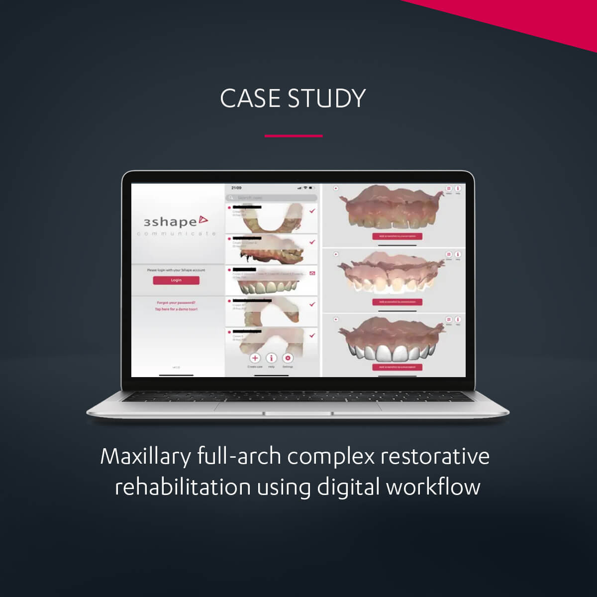 Maxillary full-arch complex restorative rehabilitation | Case Study