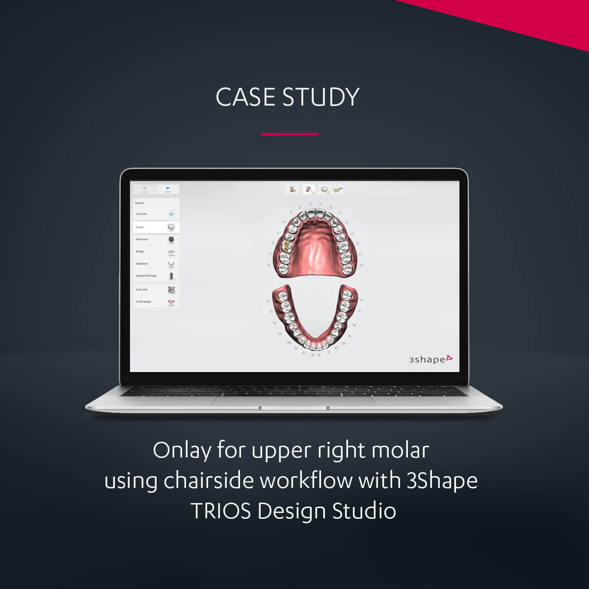 Onlay for upper right molar | Case study
