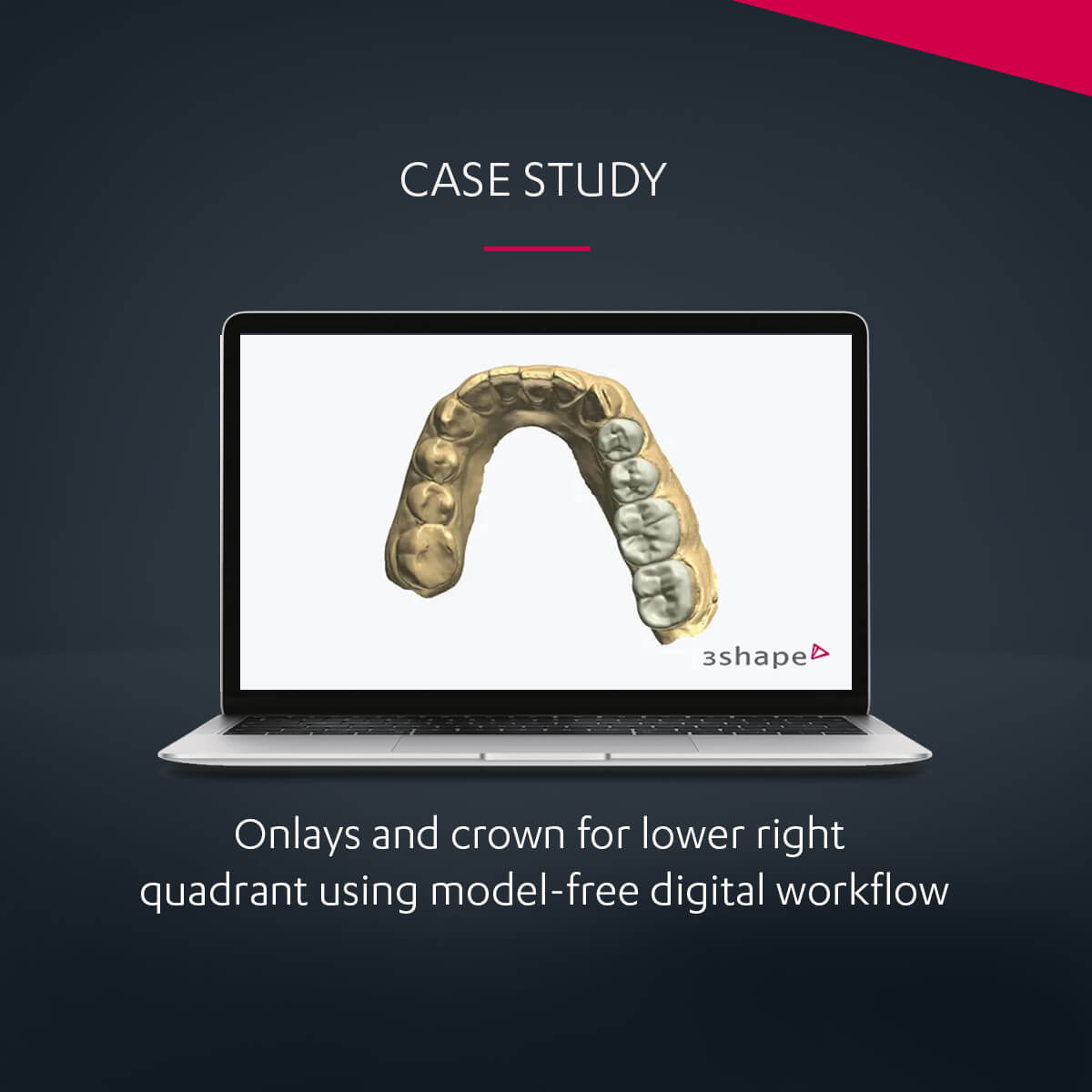 Onlays and crown for lower right quadrant | Case study