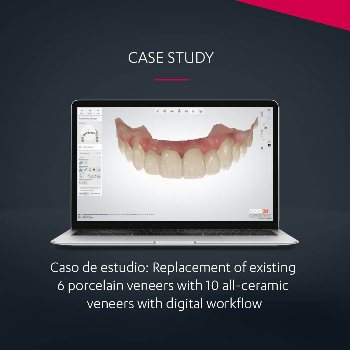 Fully digital porcelain to ceramic veneers replacement | Case study