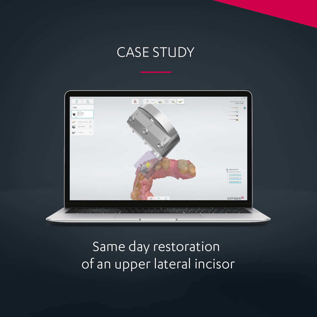 Same day restoration of an upper lateral incisor | Case Study