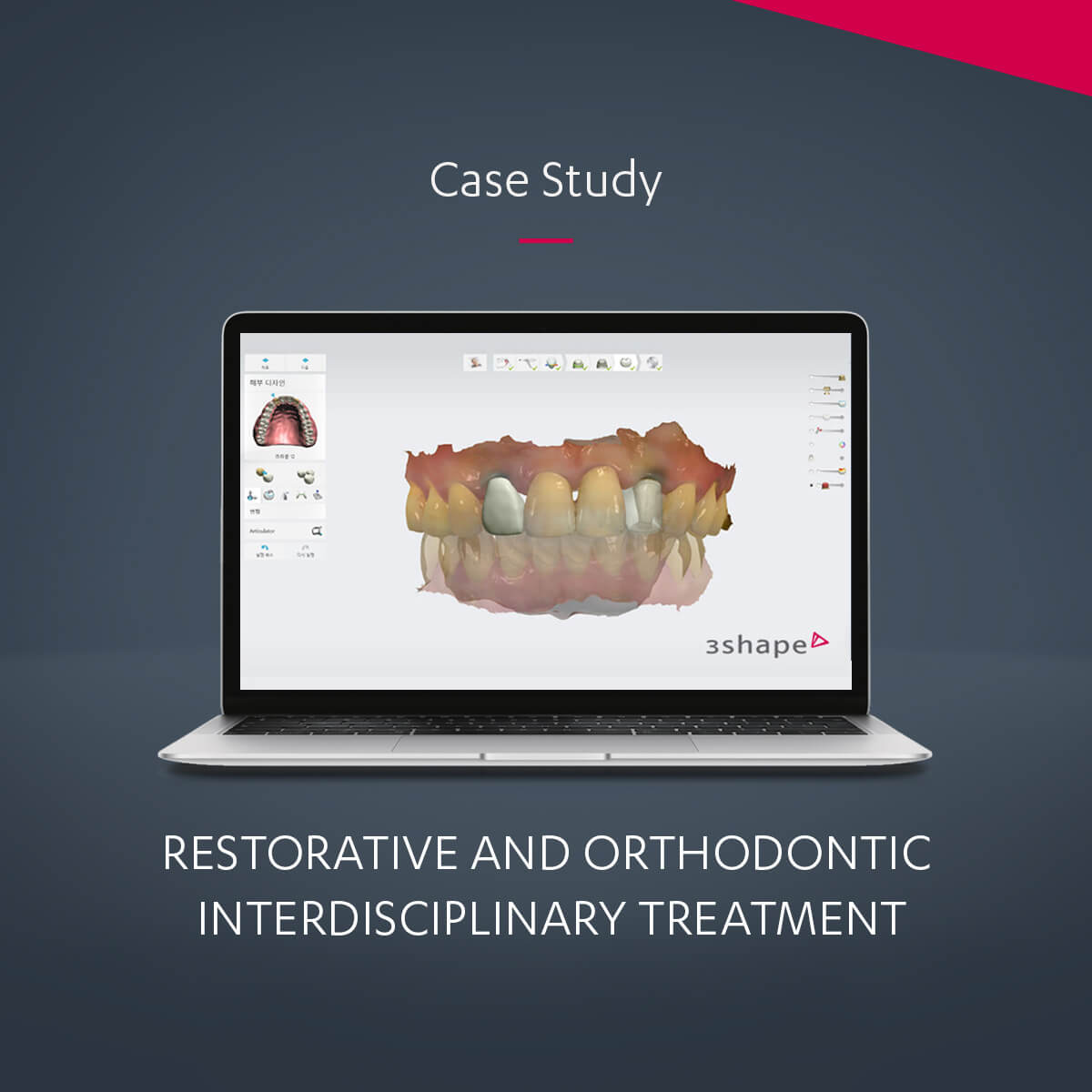 Single visit crowns and in-house printed aligner treatment | Case Study