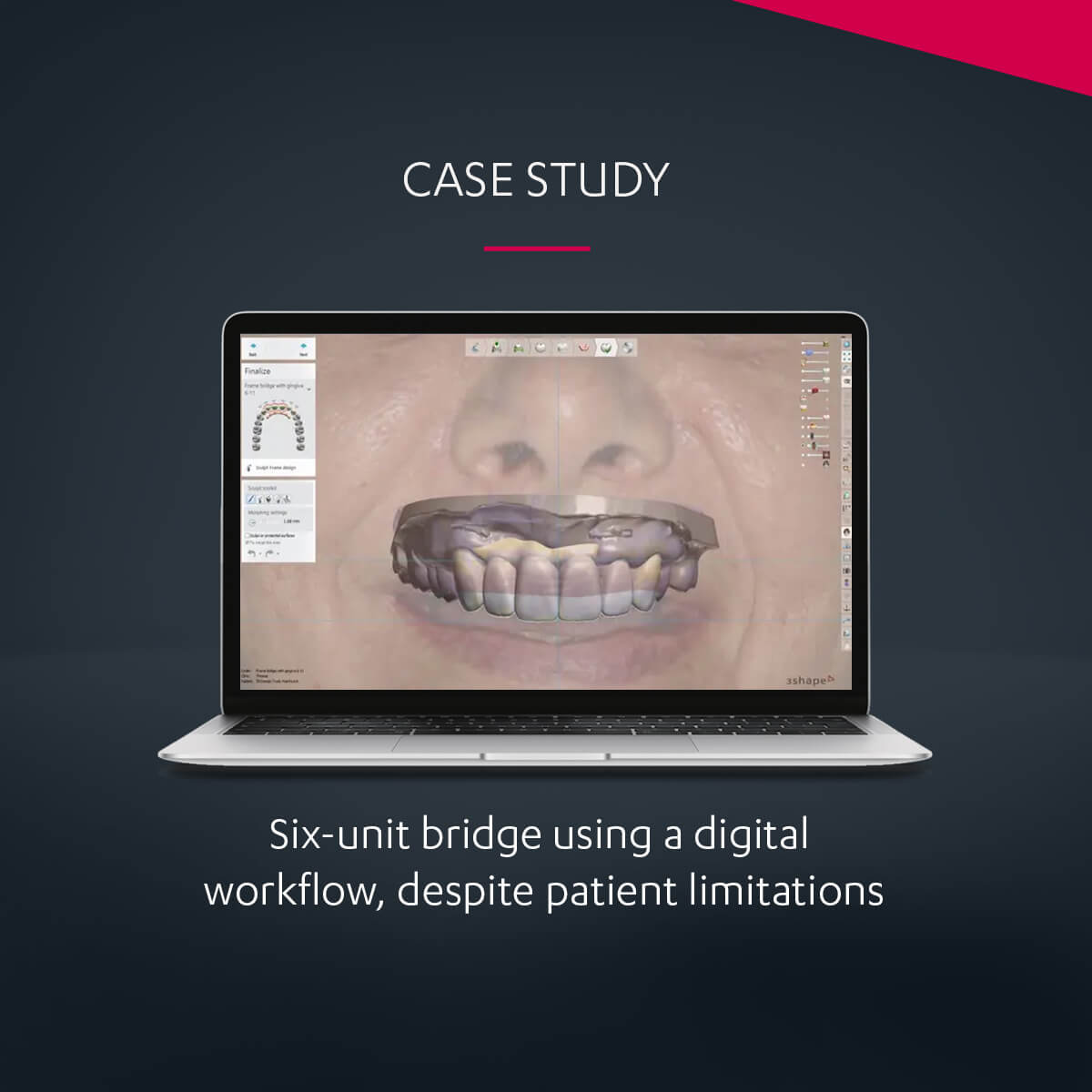 Digital workflow for six-unit bridge, despite limitations | Case study