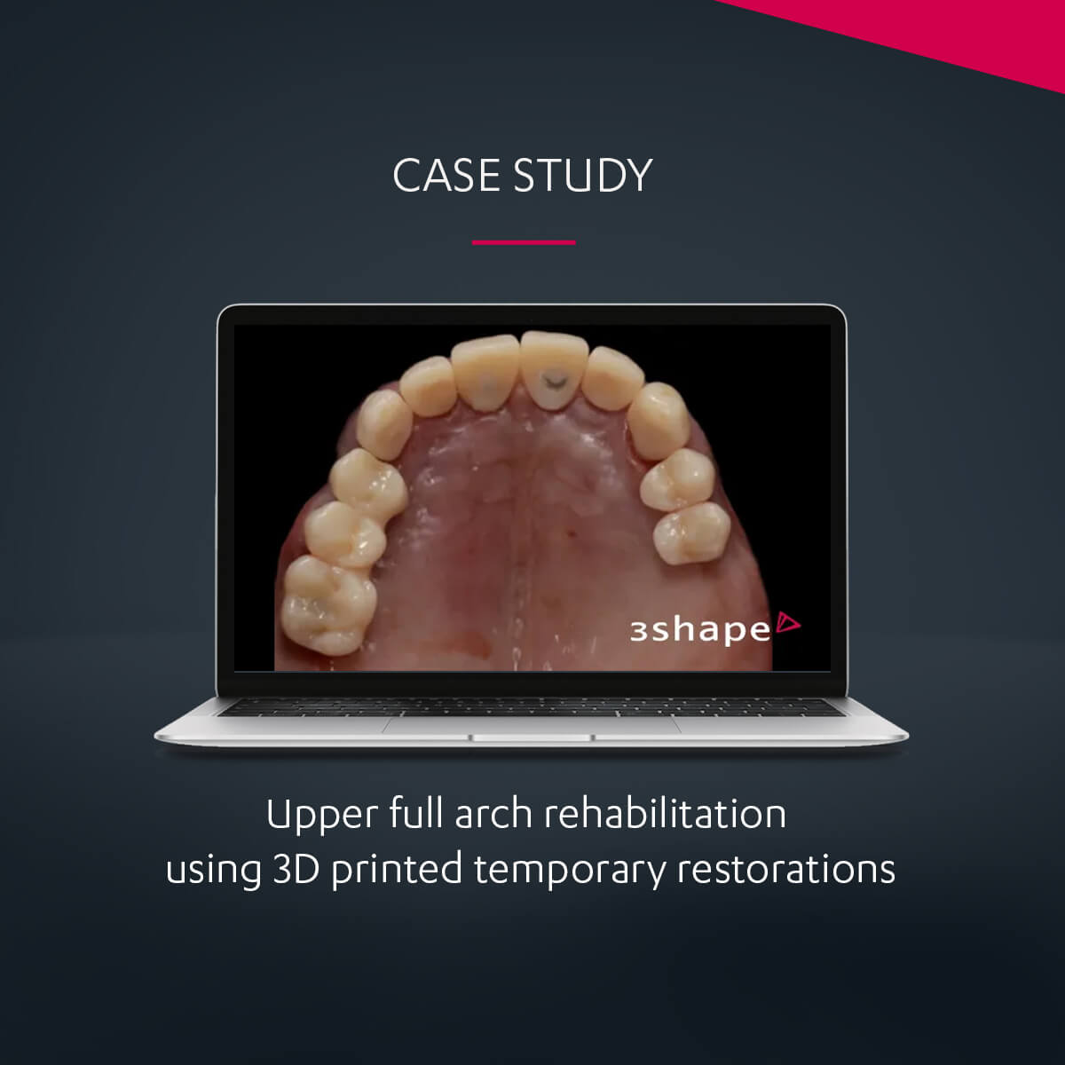 Upper full arch rehabilitation | Case study