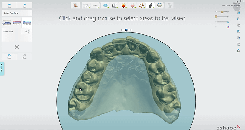 3Shape Splint Studio now available in the USA