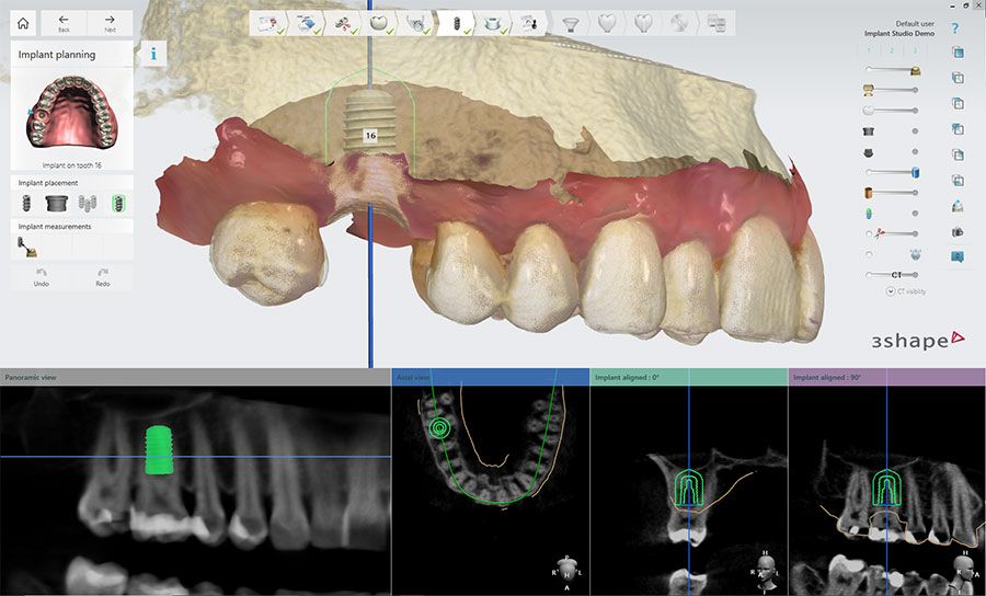3Shape Implant Studio — Software Improvement and Changes