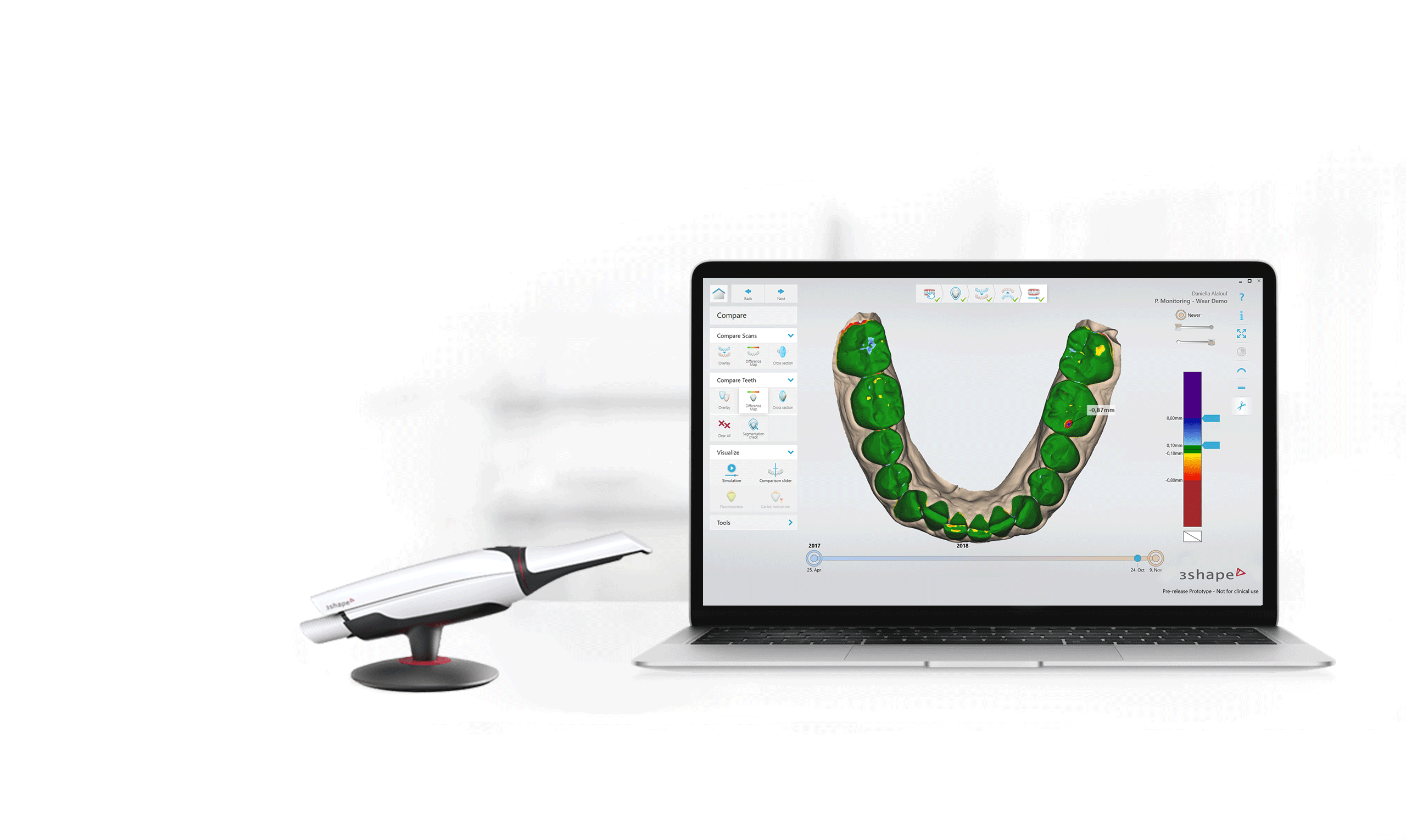 TRIOS Patient Monitoring - Visualice cambios en el estado dental